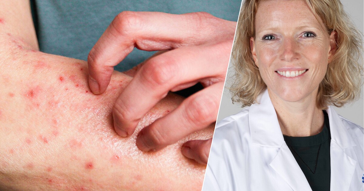 Wat is erfelijk eczeem? | Gezond | PZC.nl